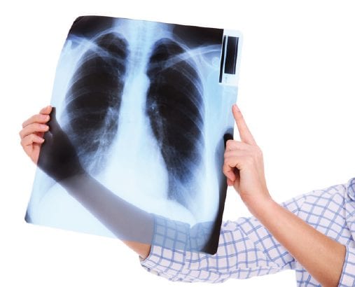 The difference between ILO and standard chest x-rays | KINNECT
